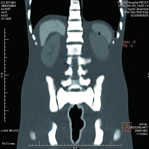 Torso Phantom para tomografia computadorizada - Simulação na saúde